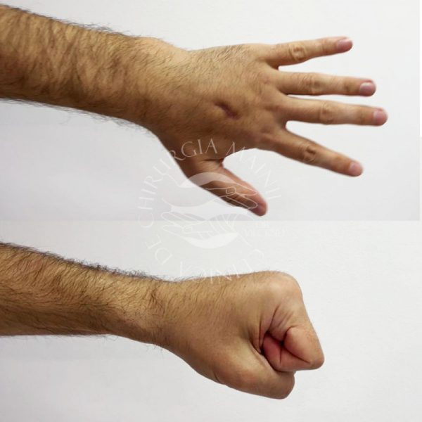 Fracturi de falange și metacarpiene | Dr. Vilcioiu Daniel